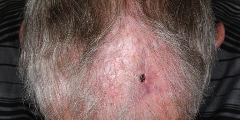 Atypical-Fibroxanthoma-of-the-Skin- AFX-Skin-Cancer-and-Reconstructive ...