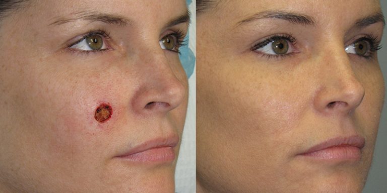 Cheek Reconstruction Gallery | Skin Cancer And Reconstructive Surgery ...