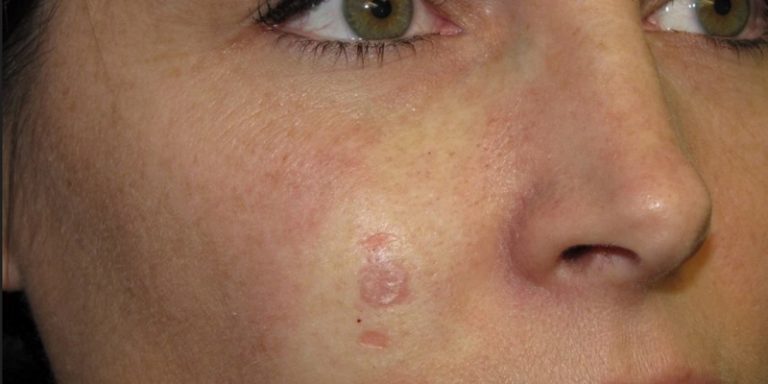 Basal-Cell-Carcinoma-Cheek-Skin-Cancer-and-Reconstructive-Surgery ...