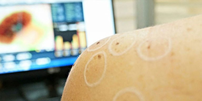 Mole Mapping | Skin Cancer And Reconstructive Surgery Center