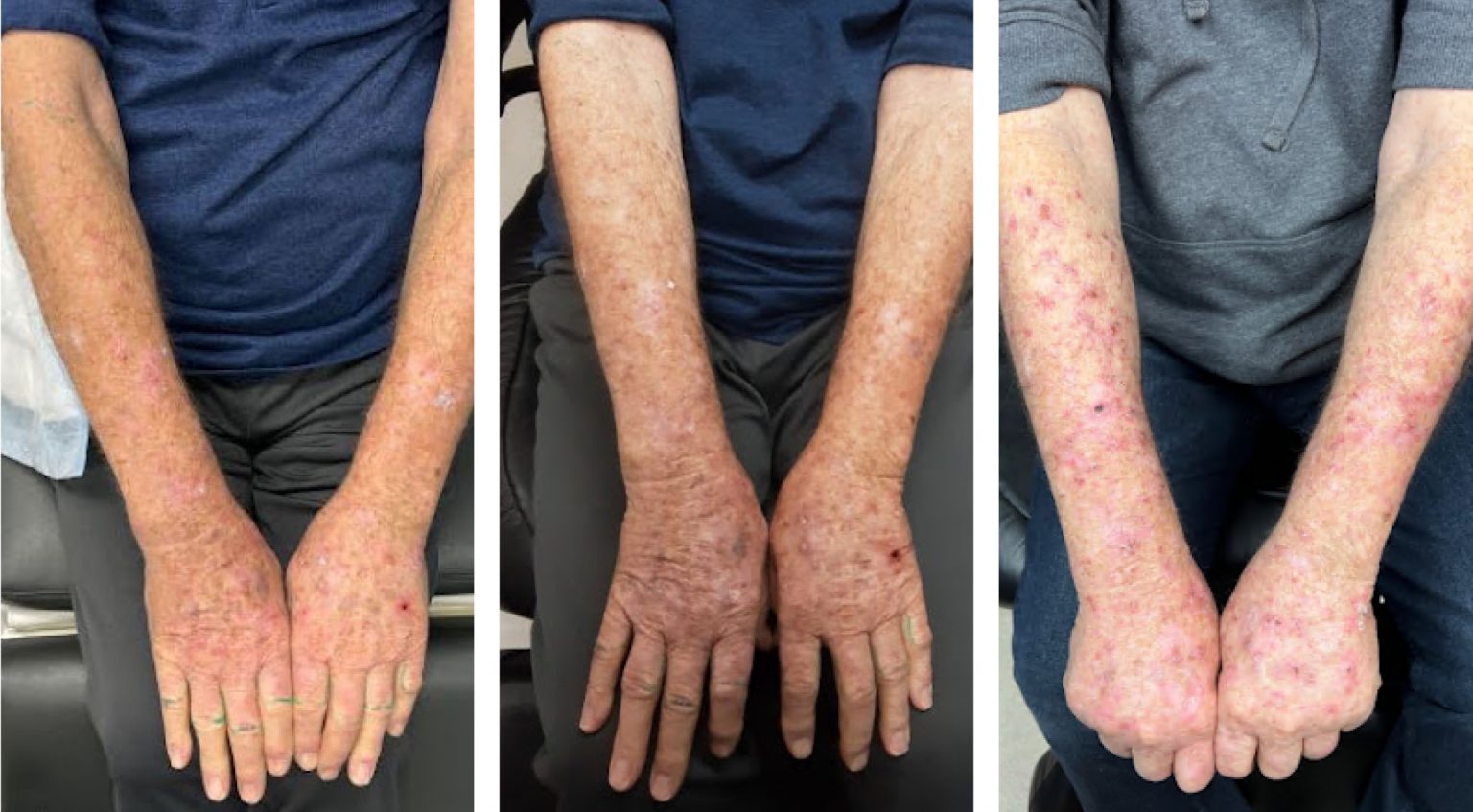 Topical Treatment For Actinic Keratoses And Skin Cancer Skin Cancer