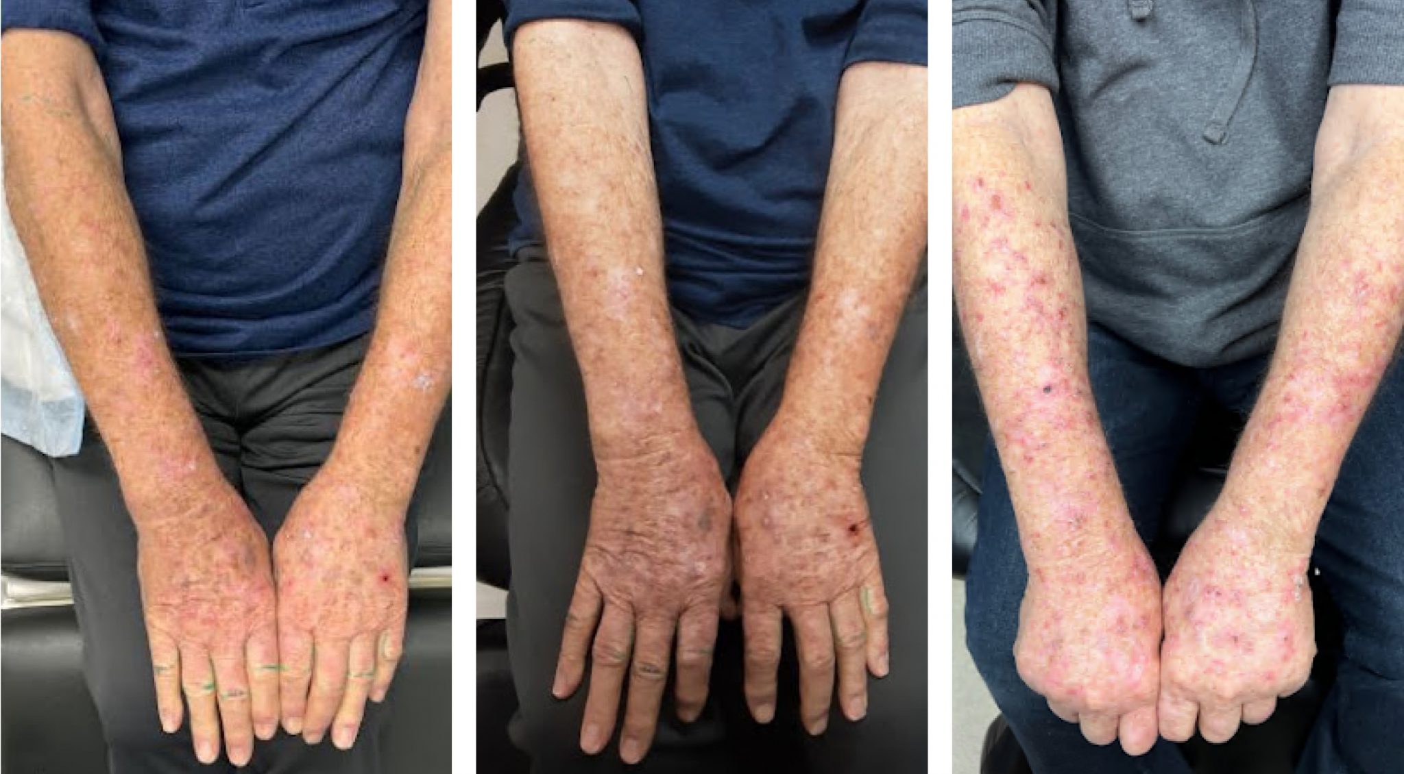 Topical Treatment For Actinic Keratoses And Skin Cancer Skin Cancer