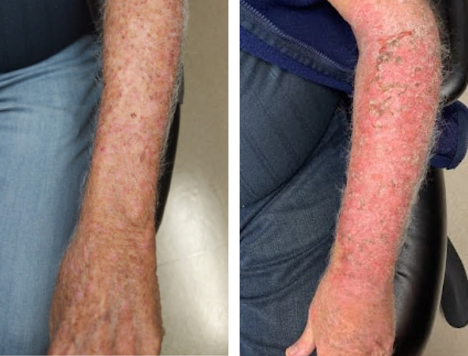 Topical Treatment For Actinic Keratoses And Skin Cancer Skin Cancer
